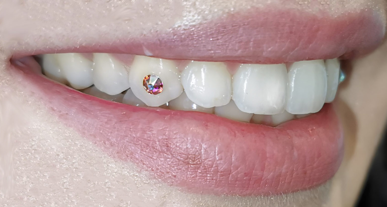 Tooth Gems - Arista Dental Clinic - Maple Ridge BC